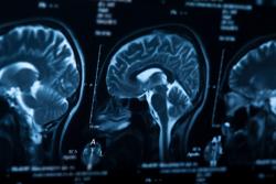 Hjernetumorer - Kræftens Bekæmpelse